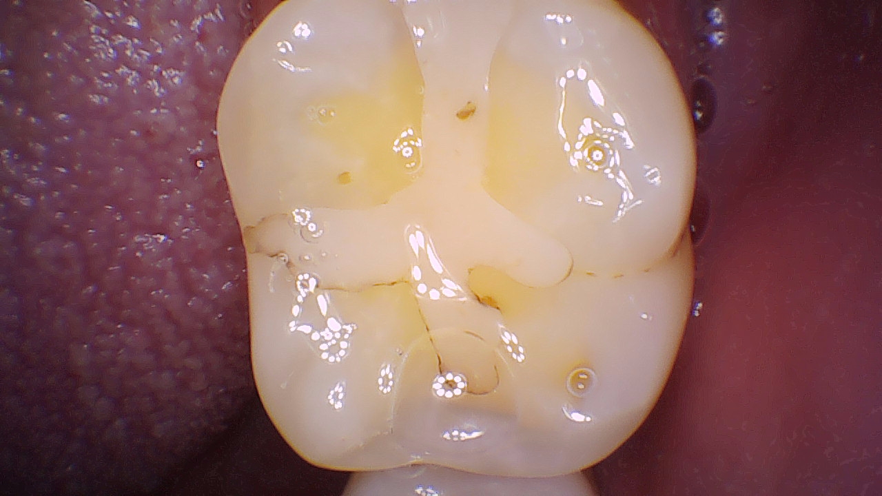 PerfectCam Intraoral Camera - IOC Snapshot