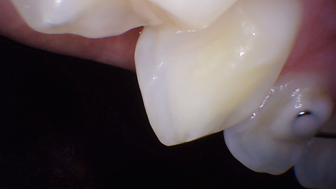 PerfectCam Intraoral Camera - IOC Snapshot