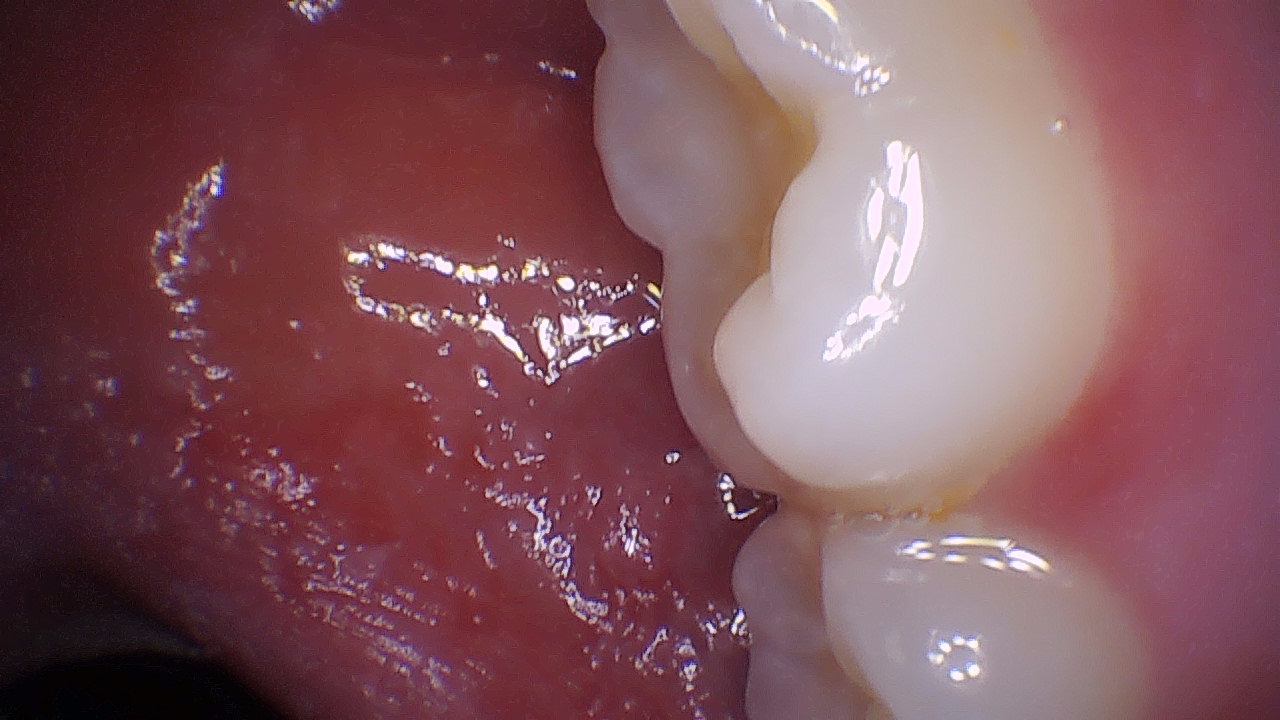 PerfectCam Intraoral Camera - IOC Snapshot