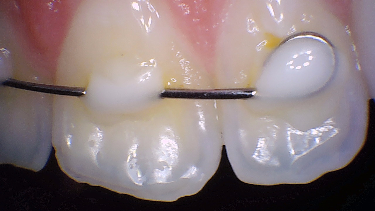 PerfectCam Intraoral Camera - IOC Snapshot